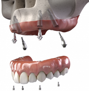 Atomica AI; Implant Guided Surgery Software - Atomica AI